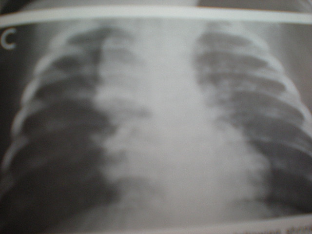 Hipertrofie de timus la sugar